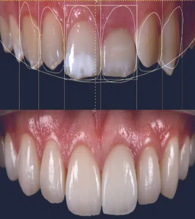 Smile Designing – smiledente